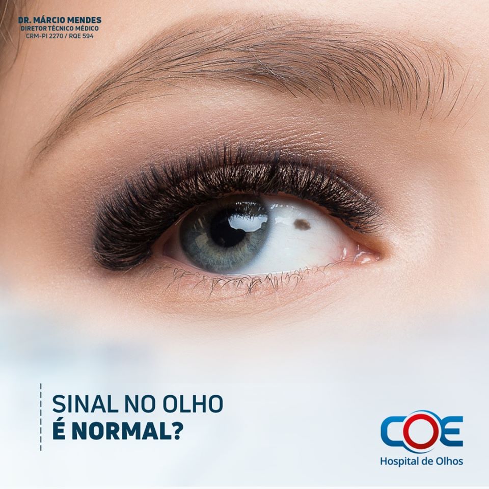Você tem sinal no olho? Saiba se isso é normal – COE Piaui